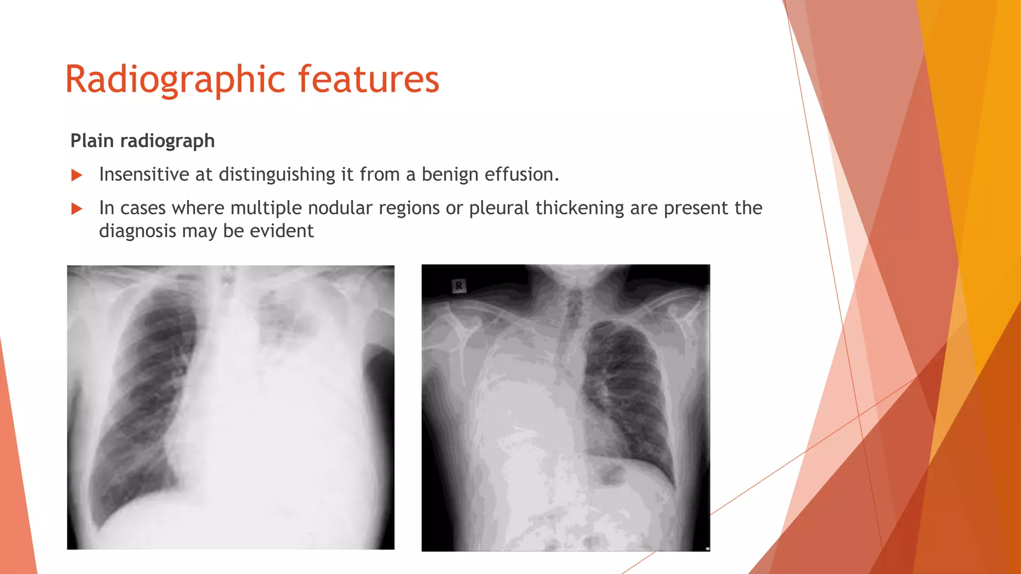 Malignant pleural effusions | PPTX