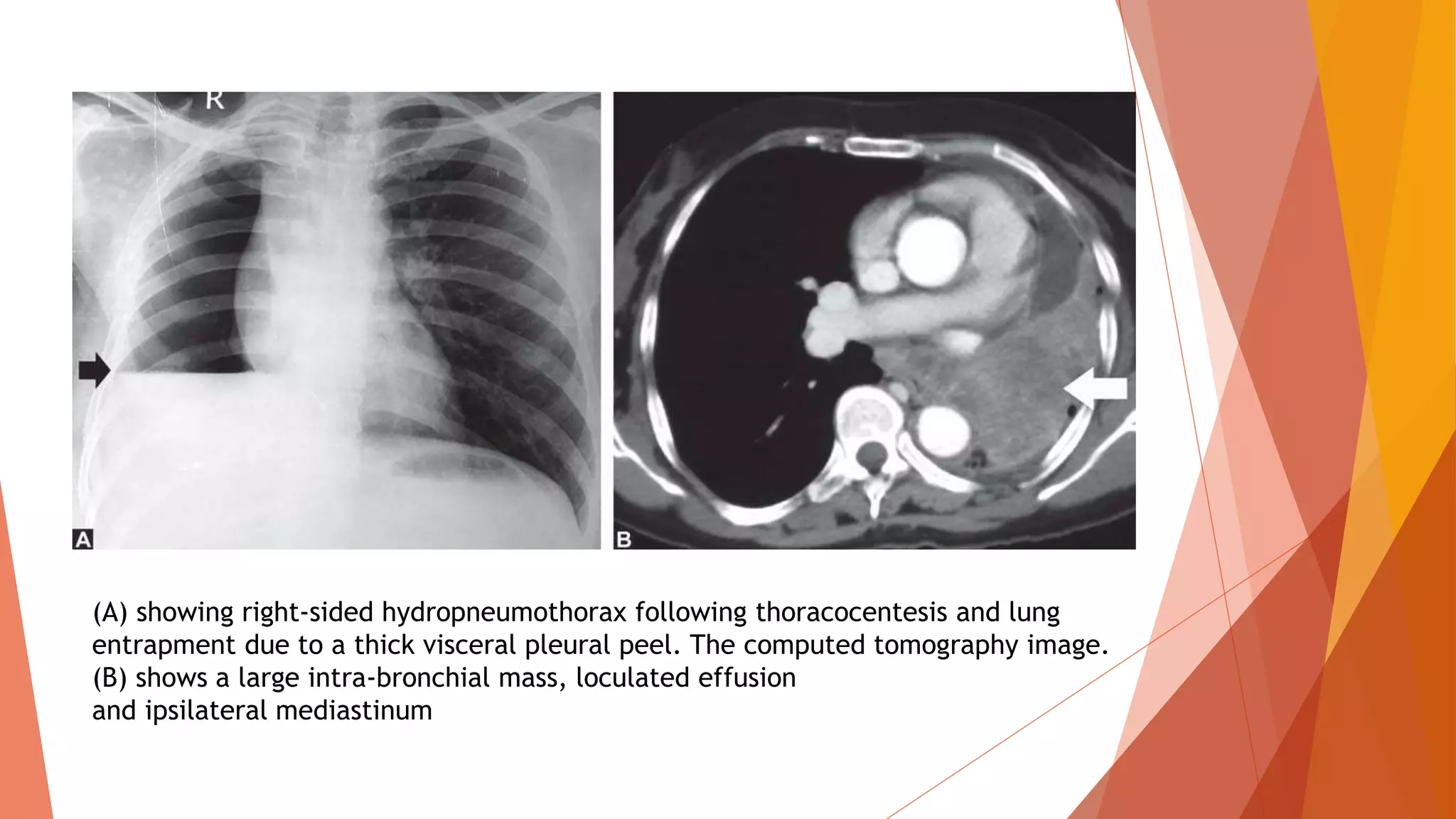 Malignant pleural effusions | PPTX