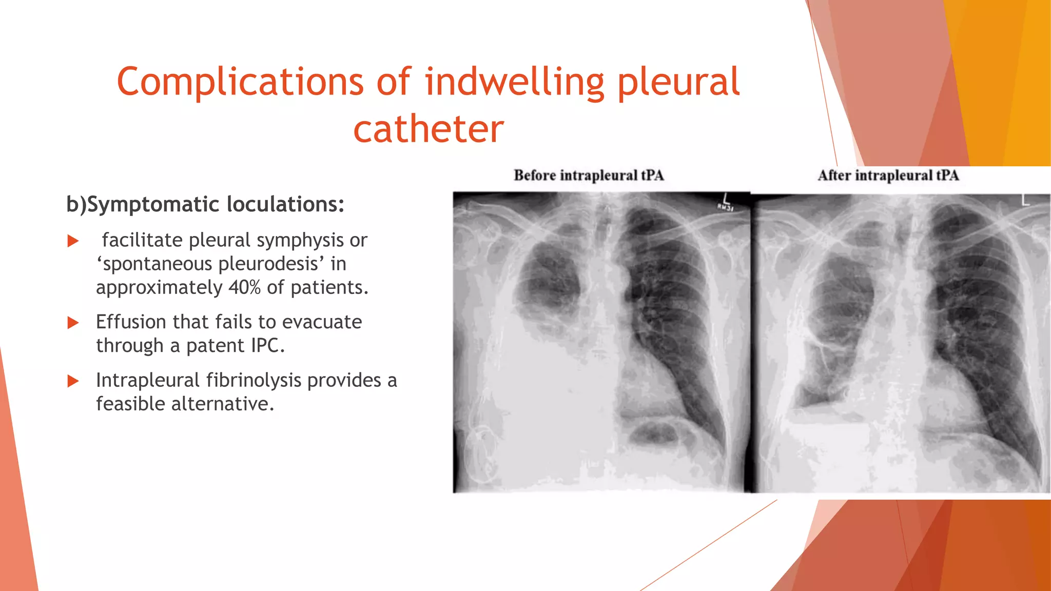 Malignant pleural effusions | PPTX