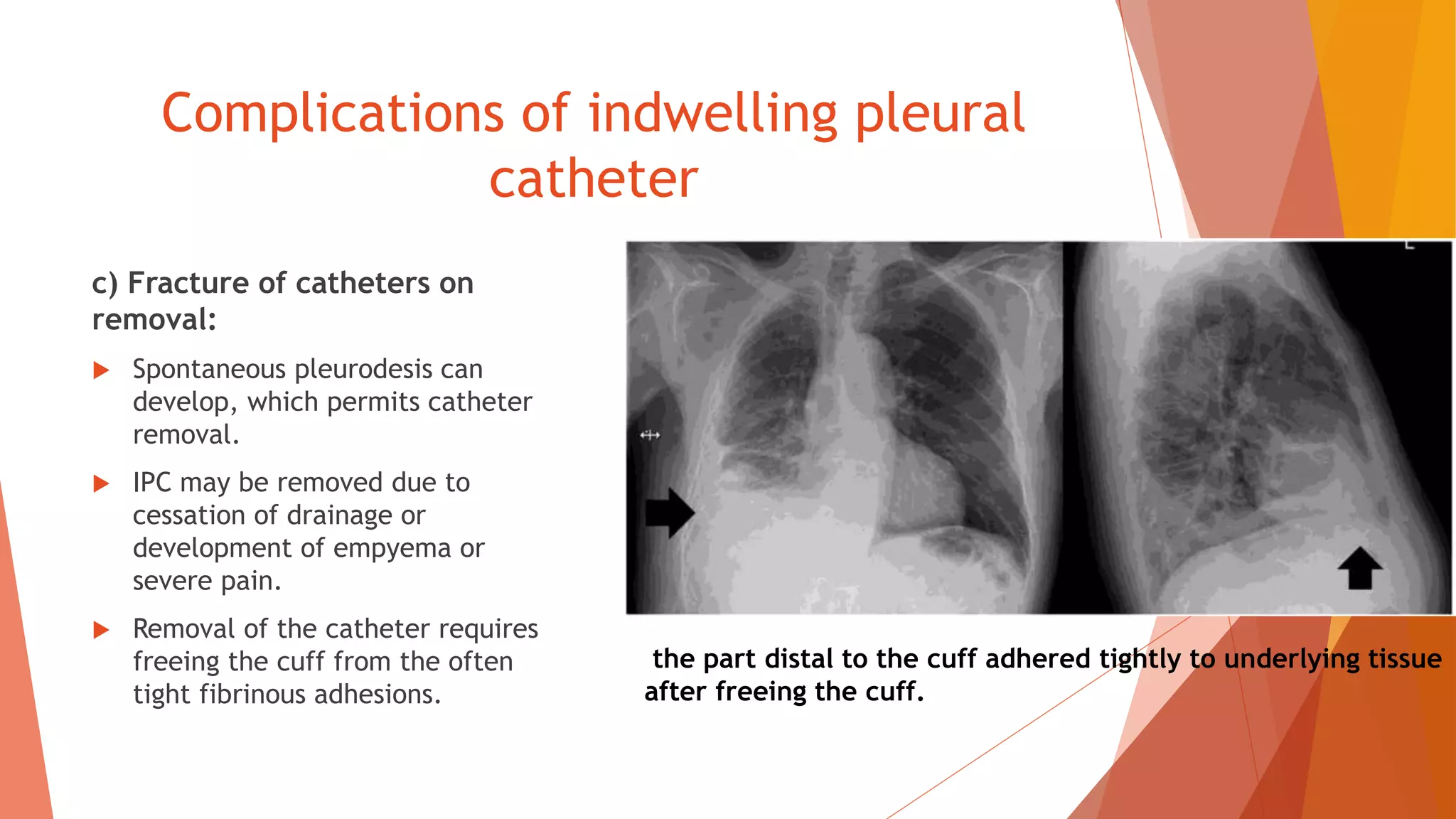 Malignant pleural effusions | PPTX