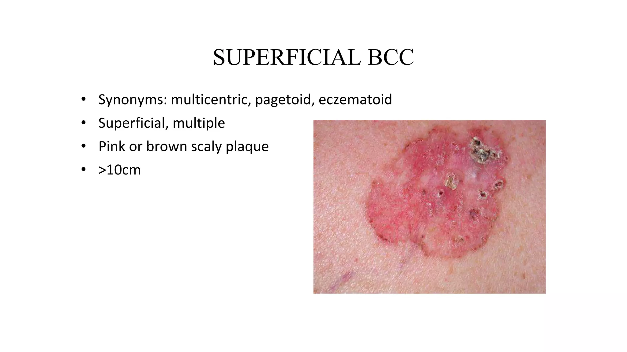 Malignant skin lesions | PPTX | Skin and Dermatology | Diseases and ...
