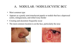 Malignant skin lesions | PPTX