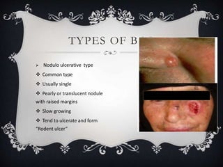 malignant skin lesions /BASIC MEDICAL KNWOLEDGE .ppt