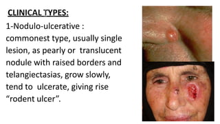 Malignant skin tumors | PPTX