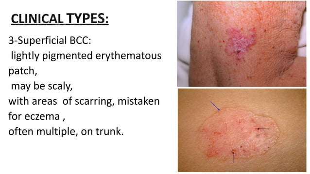 Malignant skin tumors | PPTX | Skin and Dermatology | Diseases and ...