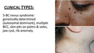 Malignant skin tumors | PPTX