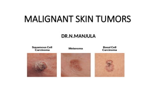 Malignant skin tumors .pptx