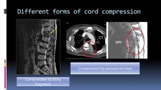 Malignant spinal cord compression | PPTX