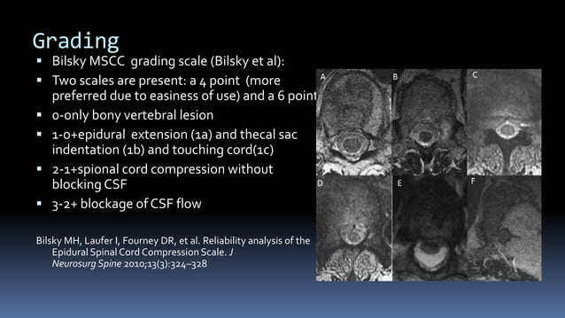 Malignant spinal cord compression | PPTX