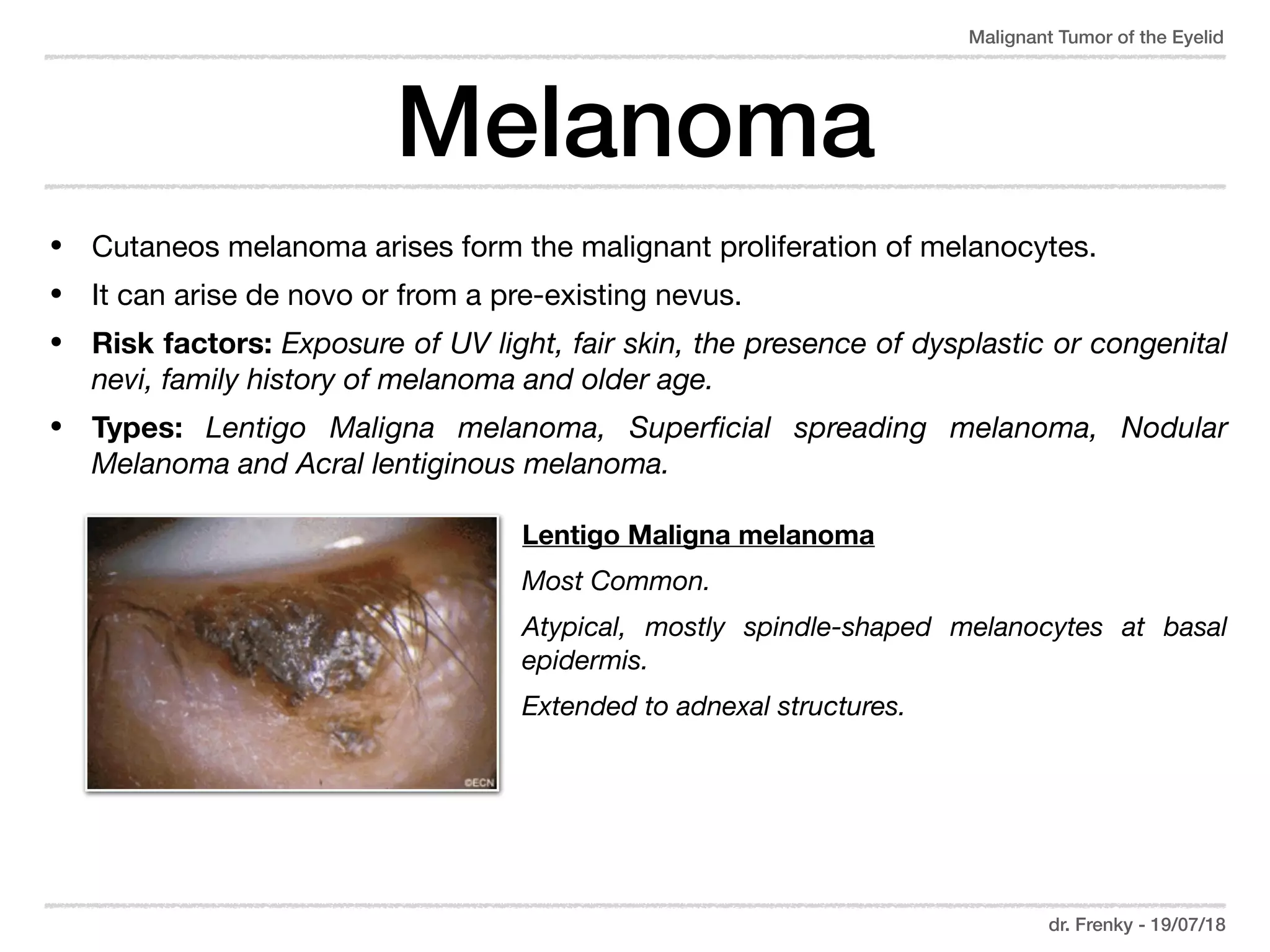 Malignant tumor of the eyelid | PDF