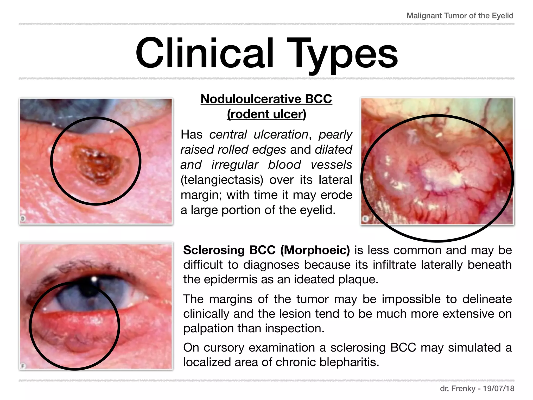 Malignant tumor of the eyelid | PDF