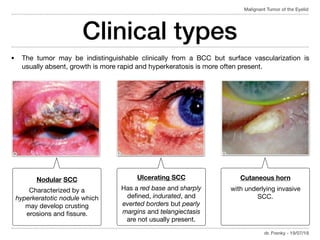 Malignant tumor of the eyelid | PDF