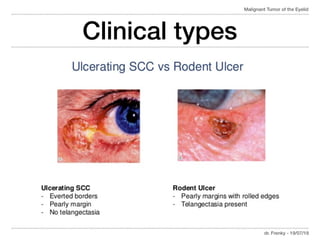 Malignant tumor of the eyelid | PDF