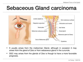 Malignant tumor of the eyelid | PDF