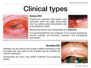 Malignant tumor of the eyelid | PDF