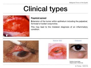 Malignant tumor of the eyelid | PDF