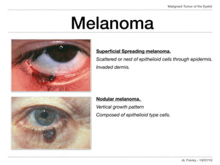 Malignant tumor of the eyelid | PDF