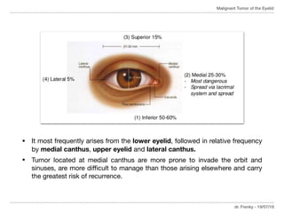 Malignant tumor of the eyelid | PDF