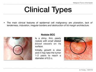 Malignant tumor of the eyelid | PDF