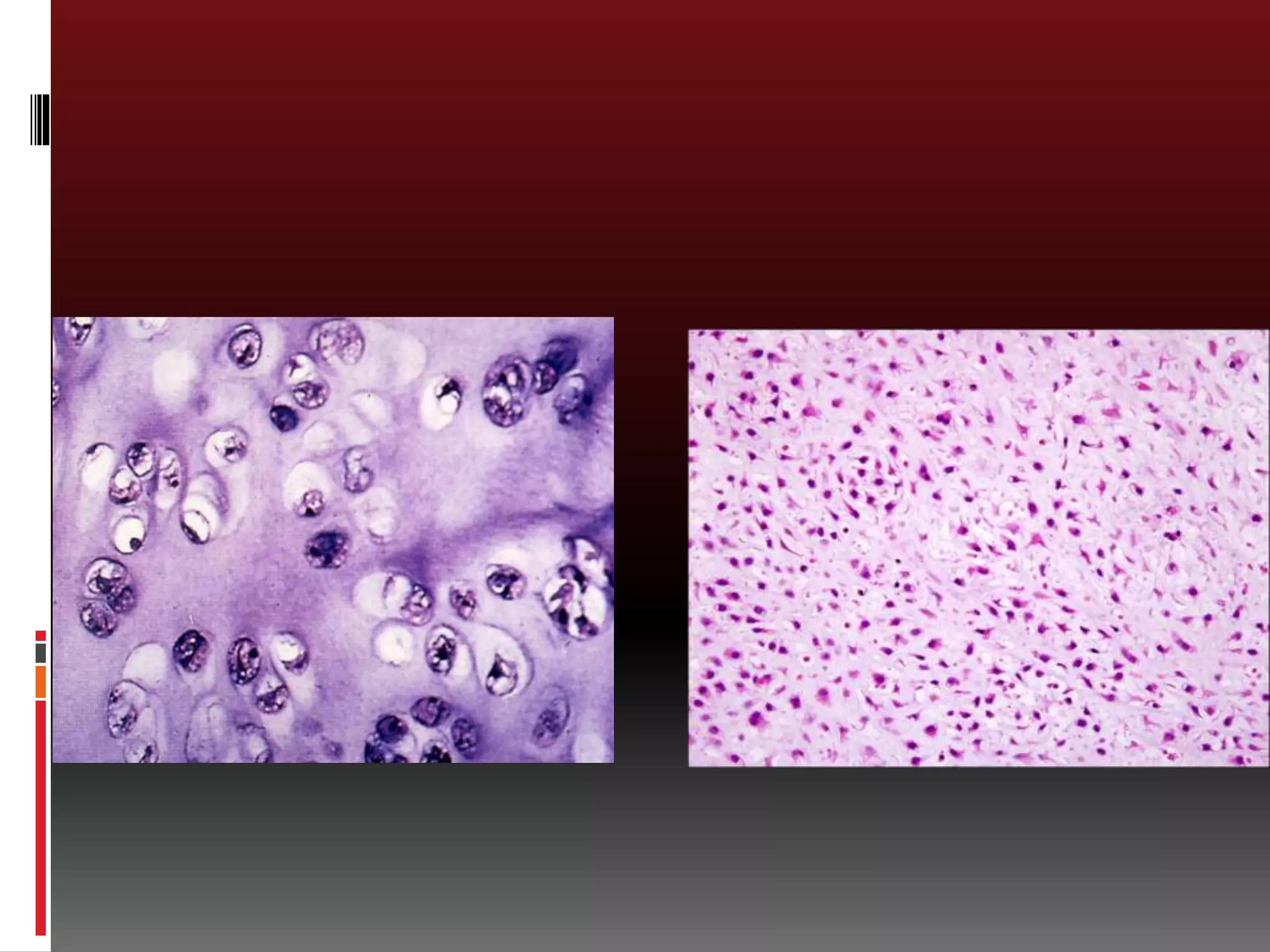 Malignant tumors of connective tissue origin | PPTX | Cancer | Diseases ...