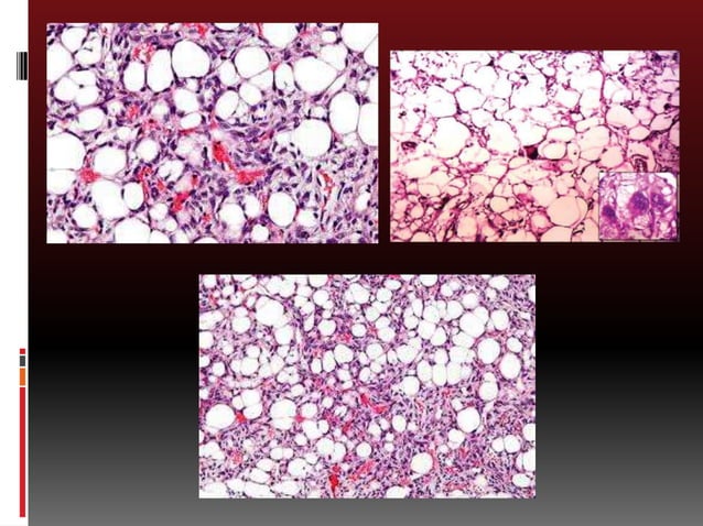 Malignant tumors of connective tissue origin | PPTX | Cancer | Diseases ...