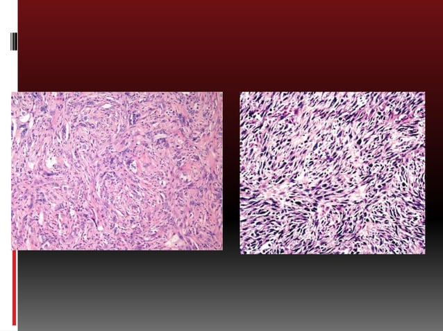 Malignant tumors of connective tissue origin | PPTX | Cancer | Diseases ...