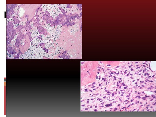 Malignant tumors of connective tissue origin | PPTX | Cancer | Diseases ...