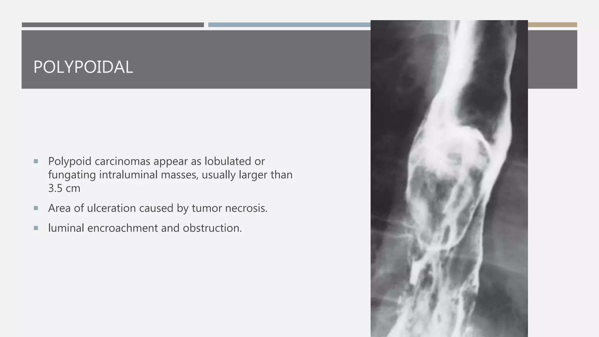 Malignant tumors of esophagus | PPTX