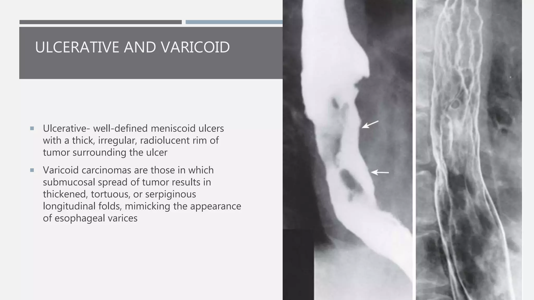 Malignant tumors of esophagus | PPTX