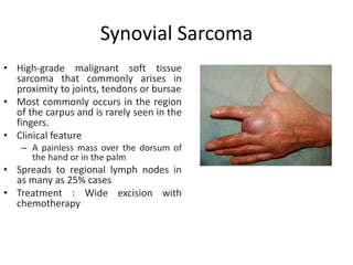 Malignant tumors of hand | PPTX