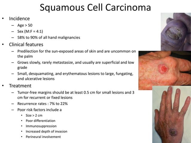 Malignant tumors of hand
