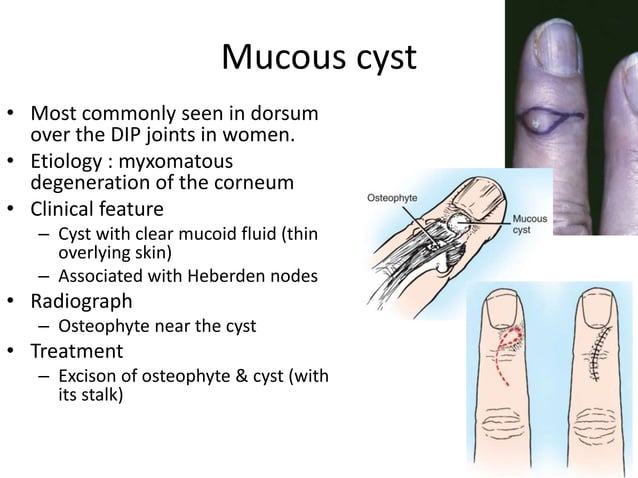Malignant tumors of hand