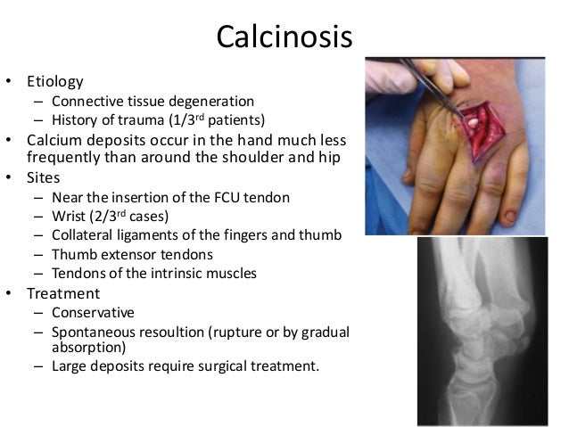 Calcium Buildup On Finger
