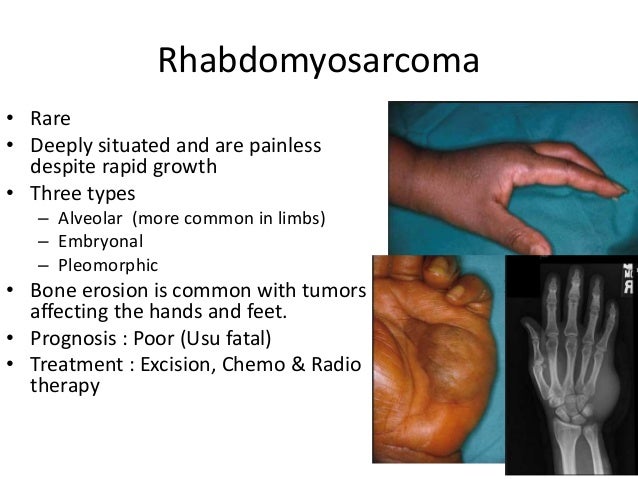 Malignant Tumors Of Hand