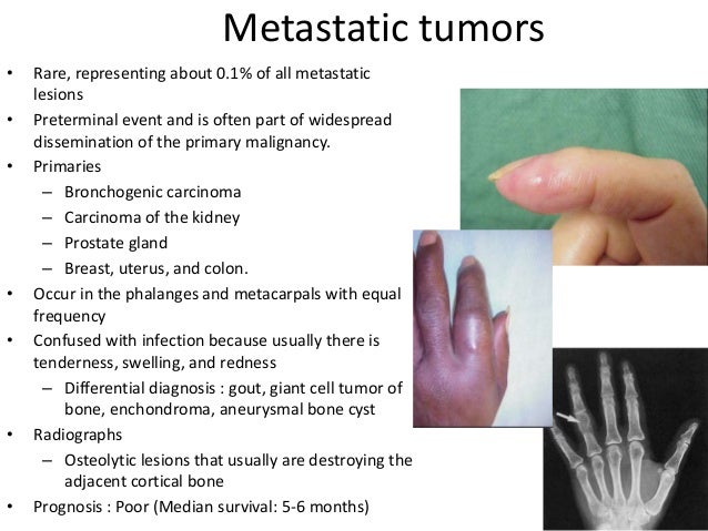 Malignant Tumors Of Hand