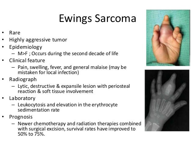 Malignant Tumors Of Hand