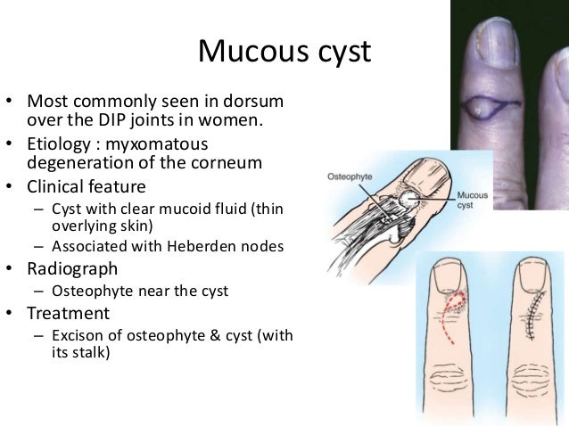 Malignant tumors of hand