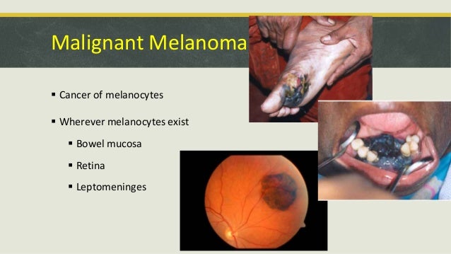 Malignant tumors of skin
