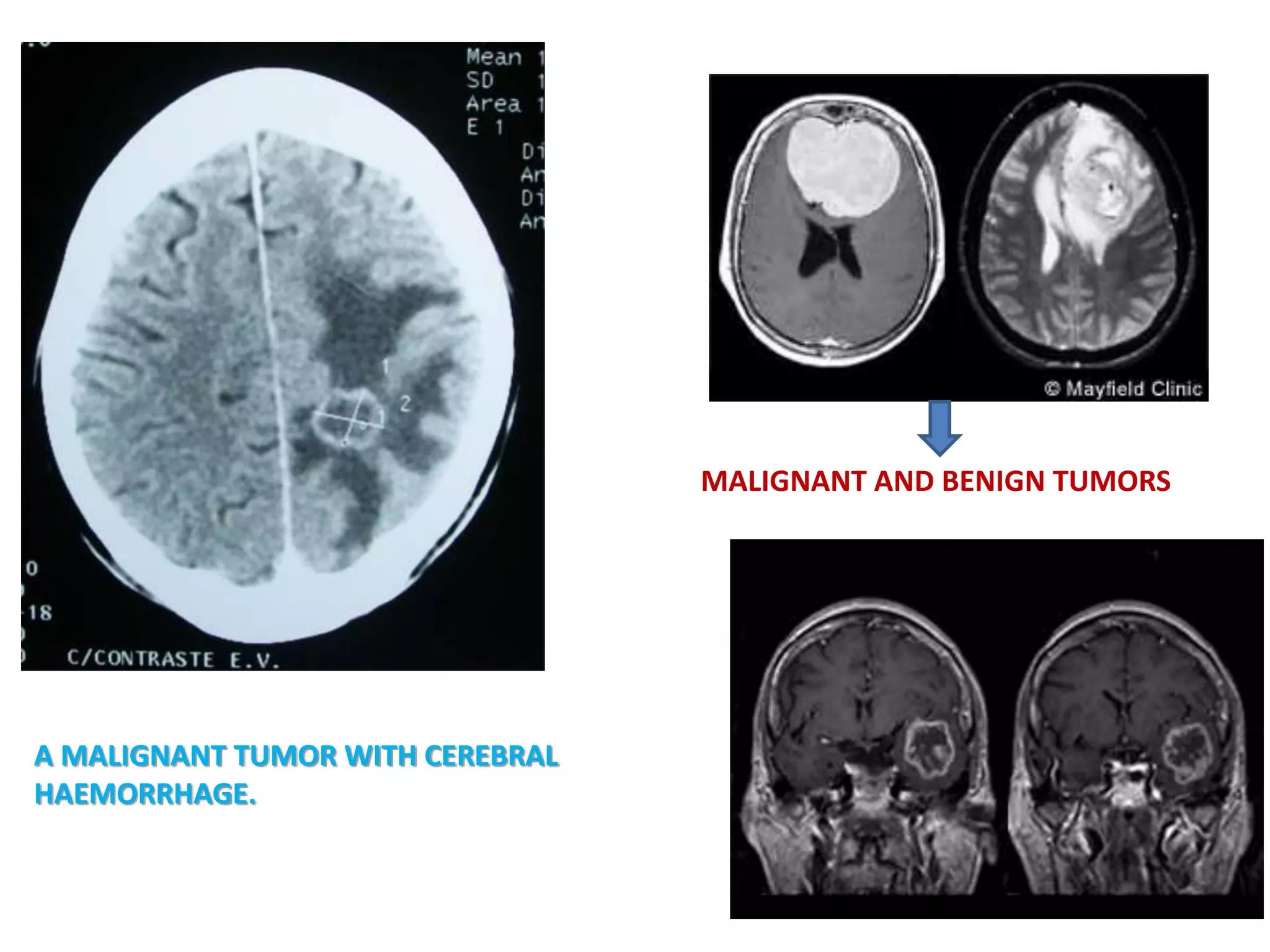 Malignant tumors of the brain | PPTX