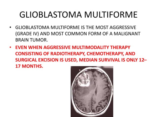 Malignant tumors of the brain | PPT