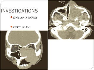 Malignant tumour of nose pns | PPT
