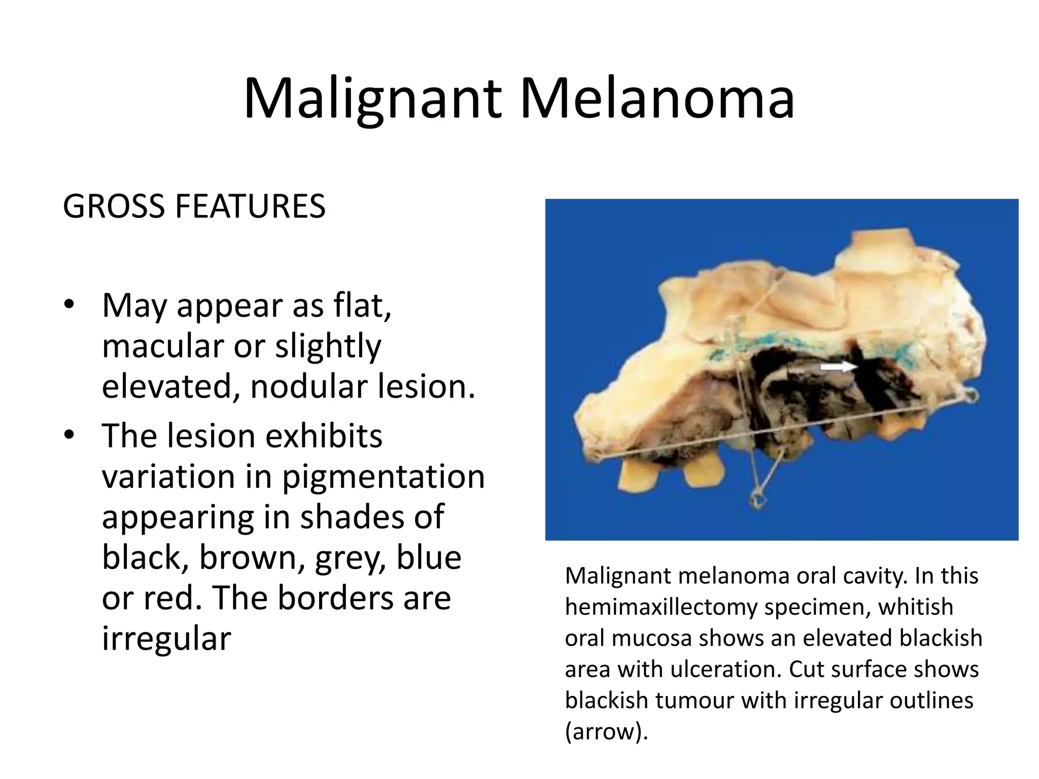 Malignant tumours of the skin | PPTX