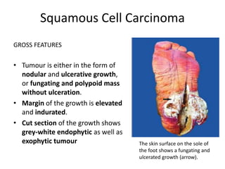 Malignant tumours of the skin | PPTX