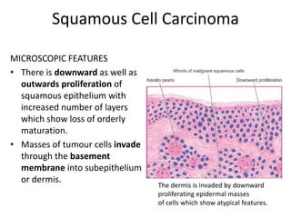 Malignant tumours of the skin | PPTX