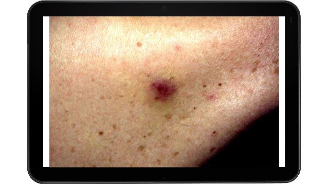 Malignant Vascular Neoplasms