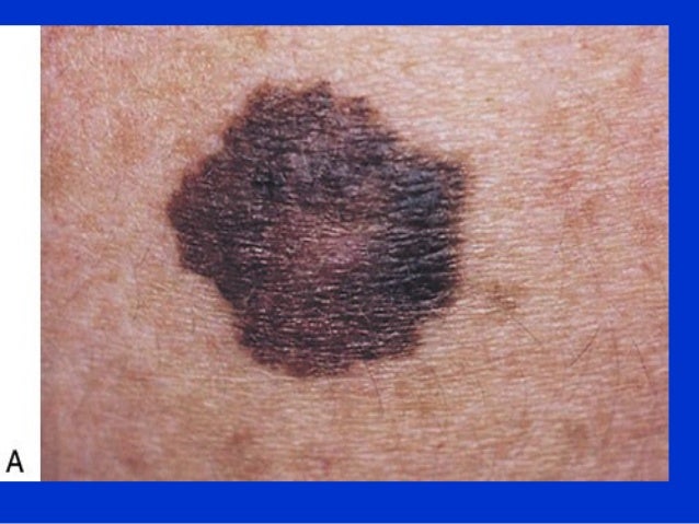Malign melanom