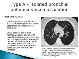 Malinosculation-bronchopulmonary sequestration and beyond | PPT