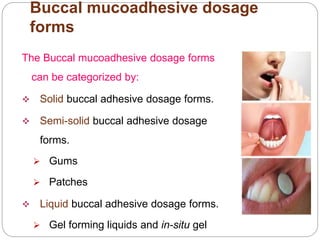Buccal Drug Delivery System Mali vv ppt | PPTX