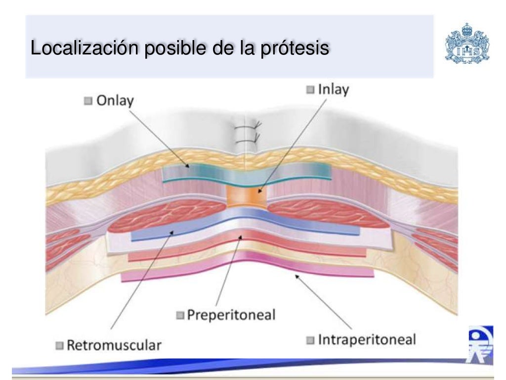 Mallas de baja vs alta densidad en hernia incisional