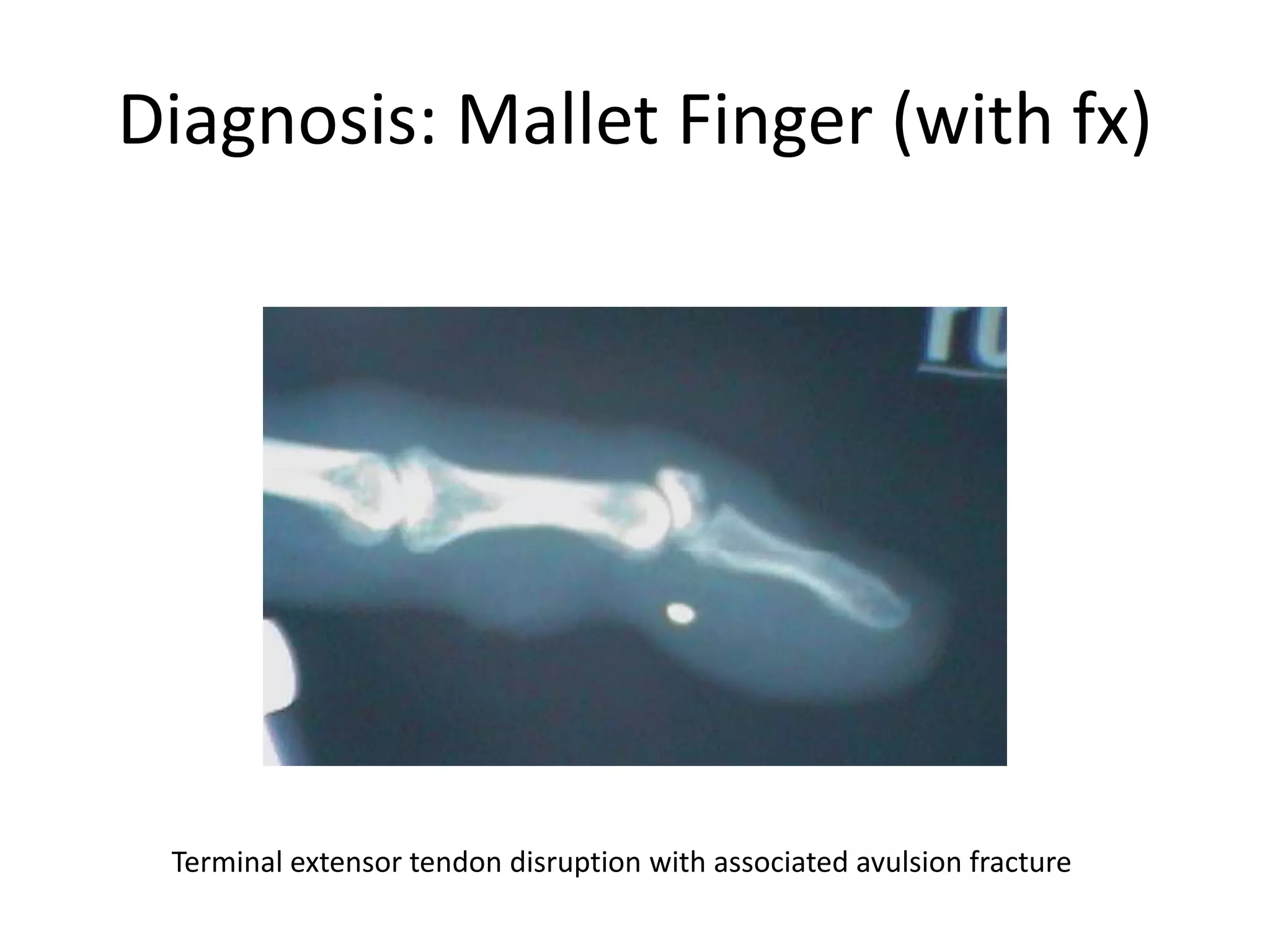 Mallet Finger Ppt Free Download